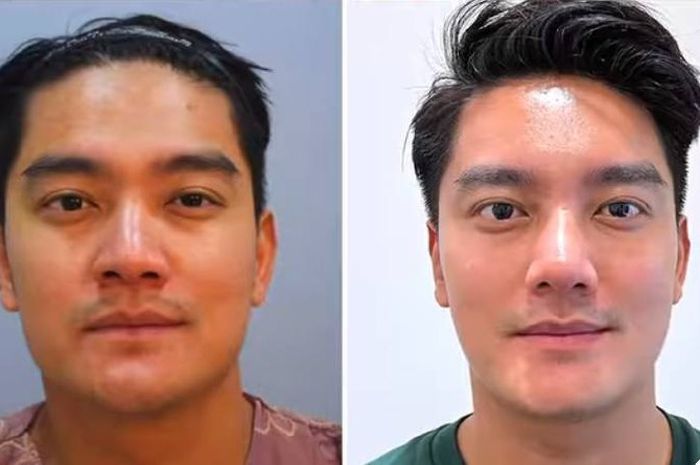 Bukan Cuma Alasan Medis, Boy William Akui Operasi Plastik Hidung Juga ...