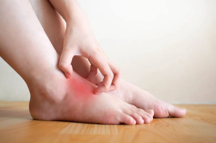 Cara Mengatasi Kutu Air di Kaki Supaya Tidak Gatal Parah, Ini Tipsnya ...