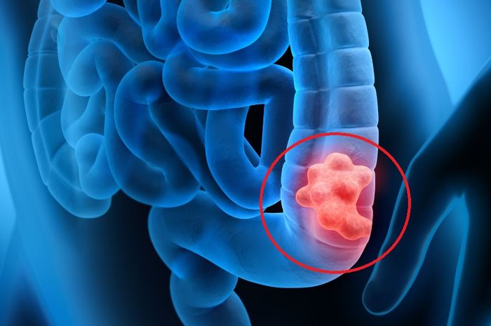 5 Gejala Kanker Usus yang Dicueki Banyak Orang, No. 2 Sering Dikira ...