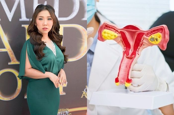 Gejala Kista Ovarium yang Jadi Penyebab Keguguran Kiky Saputri, Perempuan Wajib Tahu! - Stylo