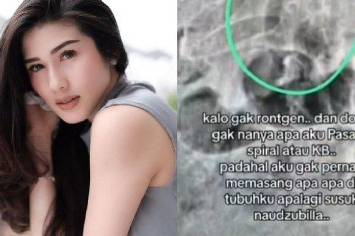 Penyebab Stevie Agnecya Meninggal Dunia, Selama Ini Pilih Rahasiakan Penyakitnya, Sahabat Ungkap ...
