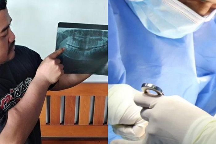 Viral Wanita Ngawi Meninggal Dunia usai Cabut Gigi Bungsu, Nasib Dokter ...