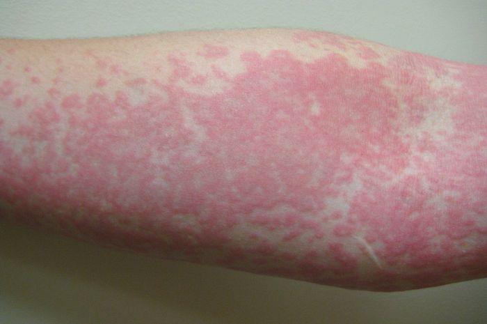 Mengenal Eksim, Penyakit Kulit yang Biasanya Muncul pada Anak-anak - Bobo