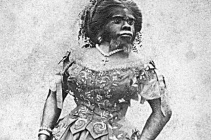 Kisah Julia Prastana, Wanita yang Dijuluki Baboon-Lady Karena Memiliki ...