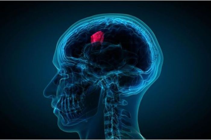 Waspada, Ini 4 Gejala Tumor Otak yang Wajib Kalian Tahu