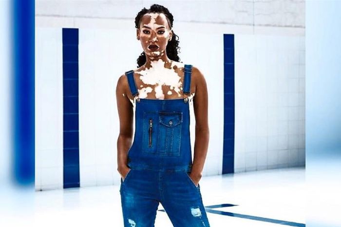 Miliki Penyakit Vitiligo, Wanita Ini Berani Tampil Sebagai Cover Girl ...
