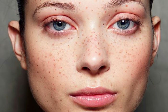 Di Wajahmu Ada Bercak Hitam? Wah Jangan-jangan Kamu Alami Ini