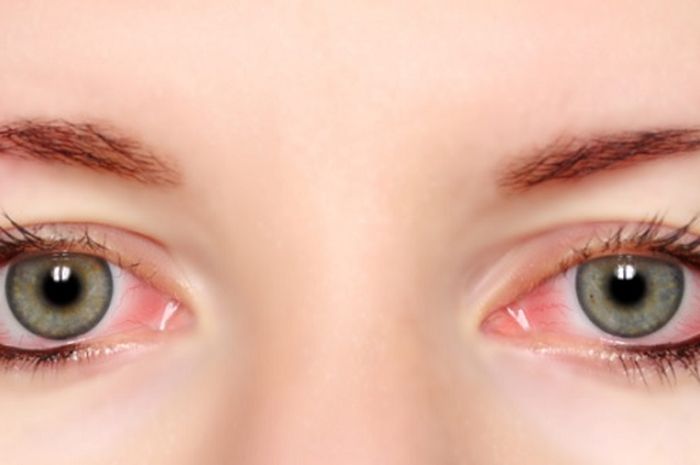 3 Masalah Mata Merah yang Perlu Diwaspadai, Nomor 3 kok Berpasir?