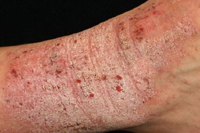 Wah, Ternyata Ini loh 4 Cara Mudah Untuk Singkirkan Eksim!