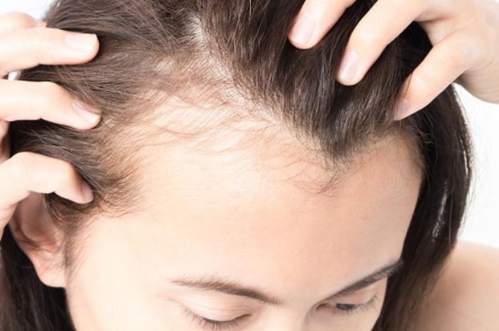 Kepala Botak Ternyata Bisa Jadi Pertanda Penyakit Ini, Bahaya Nggak ya?