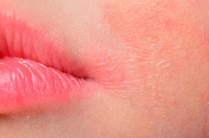 4 Cara Alami Untuk Kurangi Gejala Eksim, Gimana Caranya tuh?