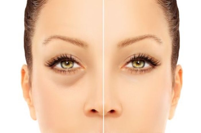 Sering Begadang Bikin Matamu Jadi Kayak Panda? 5 Cara Ini Ampuh Untuk ...