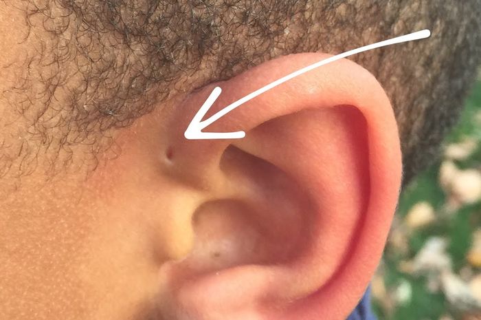Ada Lubang Kecil di Telinga? Nggak Usah Khawatir, Ini Penjelasannya - Hai