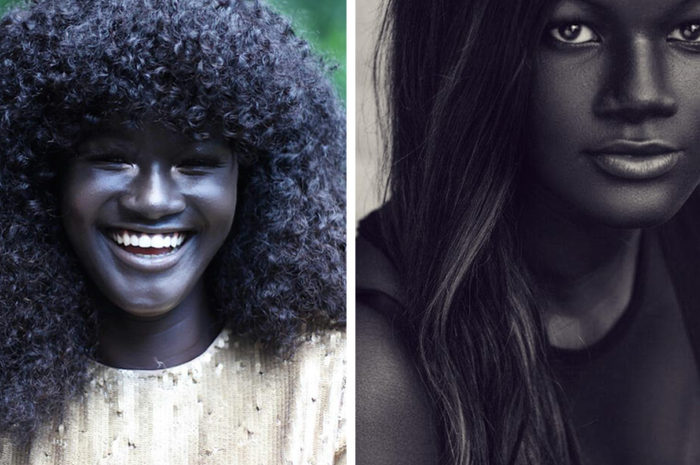 Dihina Selama Bertahun-tahun karena Kulit Hitam Legam, Perempuan Ini ...