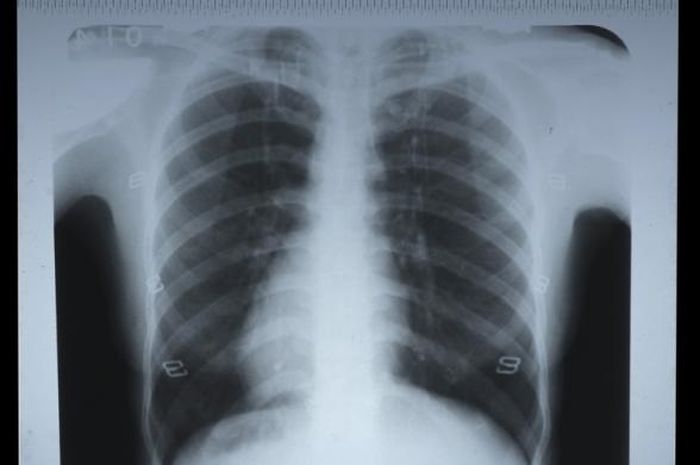 Sinar Rontgen, Bisa Menembus Dada tapi Sangat Berguna untuk Dunia ...