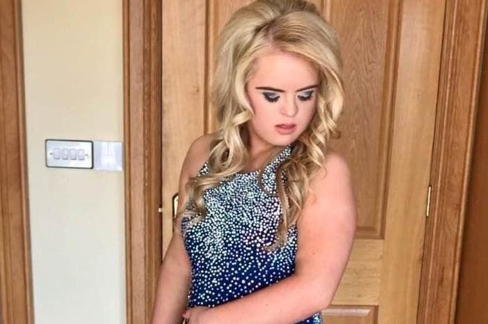 Kate Grant, Penderita Sindrom Down yang Siap Memulai Kariernya Sebagai Model - Intisari