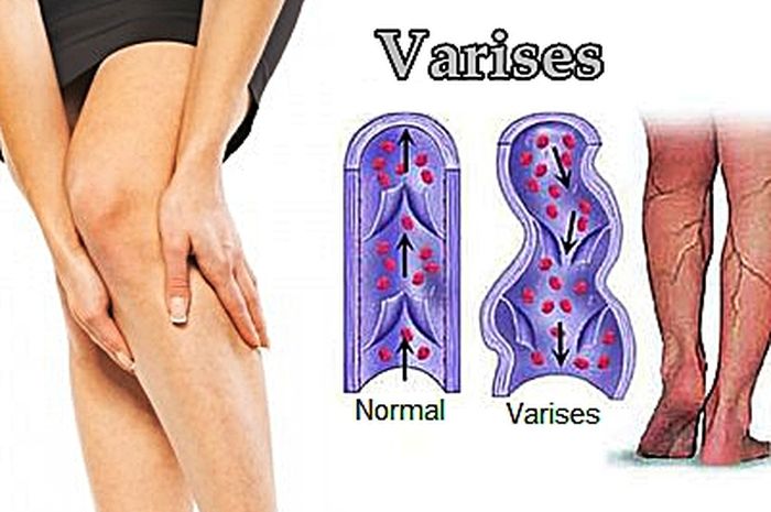 Baik Berdiri atau Duduk Terlalu Lama, Dua-duanya Memicu Terjadinya ...