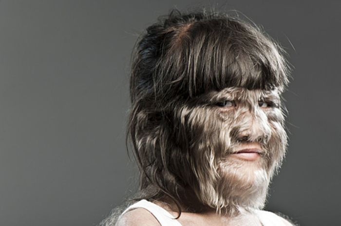 Mengenal Sindrom Werewolf, Kondisi yang Ditandai Tumbuhnya Bulu Halus ...