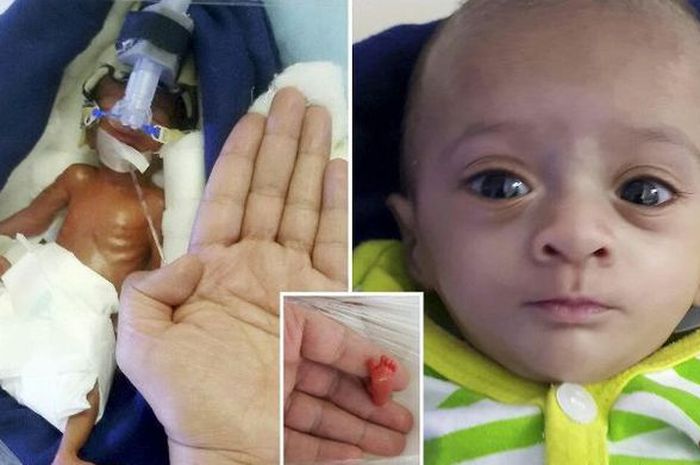 Inilah Kisah Manushi, Salah Satu Bayi Terkecil di Dunia yang Berjuang ...