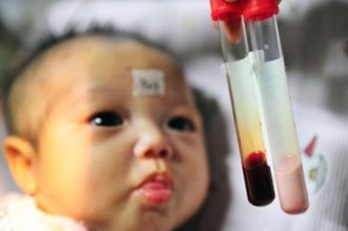 Anemia Ganggu Tumbuh Kembang Bayi - Nakita