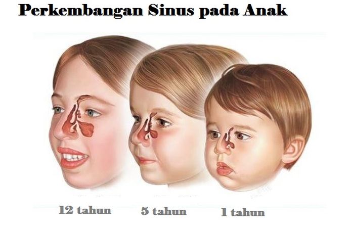 Kenali Penyebab Sinusitis - Nakita