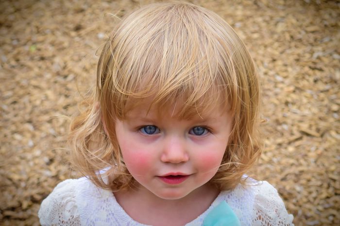 Kenali Penyakit Slapped Cheek Syndrome Pada Anak-anak - Nakita