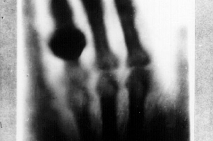 Sinar-X, Penolong yang Berbahaya - National Geographic