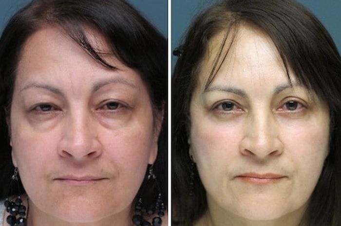 Mata Sayu dan Tampak Tua Bisa Diperbaiki dengan Teknik Blepharoplasty ...