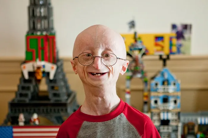 6 Hal yang Harus Diketahui dari Sam Berns yang Menderita Penyakit ...