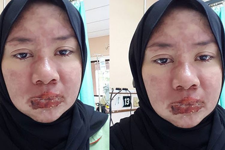 Berita Sindrom Steven Johnson Terbaru Hari Ini - Grid.ID