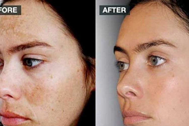 Berita Hilangkan Flek Hitam Pakai Bawang Merah Terbaru Hari Ini - Grid.ID