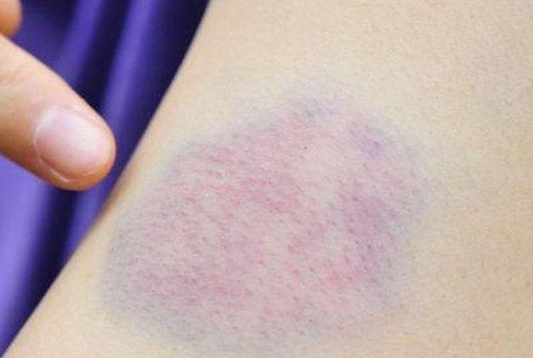 Memar di Tubuh Sering Muncul Tiba-Tiba, Ternyata Bisa Jadi Ini ...