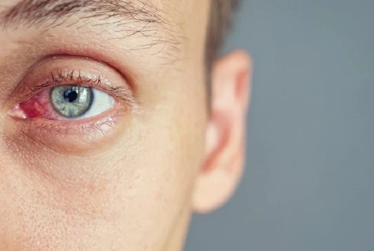 4 Cara Mengatasi Mata Merah Secara Alami Tanpa Konsumsi Obat - Kids