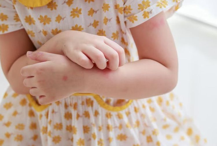Merah dan Gatal, Ini 5 Bahan Alami untuk Mengobati Ruam pada Kulit Anak ...