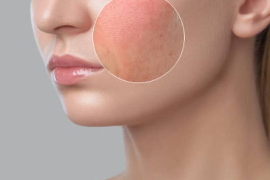 Berita Kulit Iritasi Terbaru Hari Ini - Grid.ID