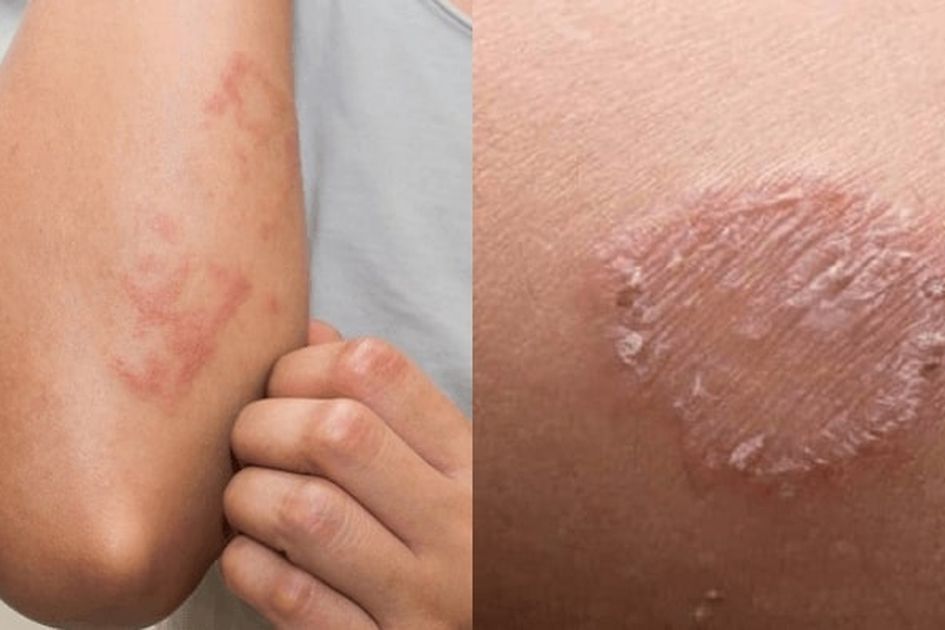 Berita Perbedaan Kadas Dan Kurap Terbaru Hari Ini - Grid Health