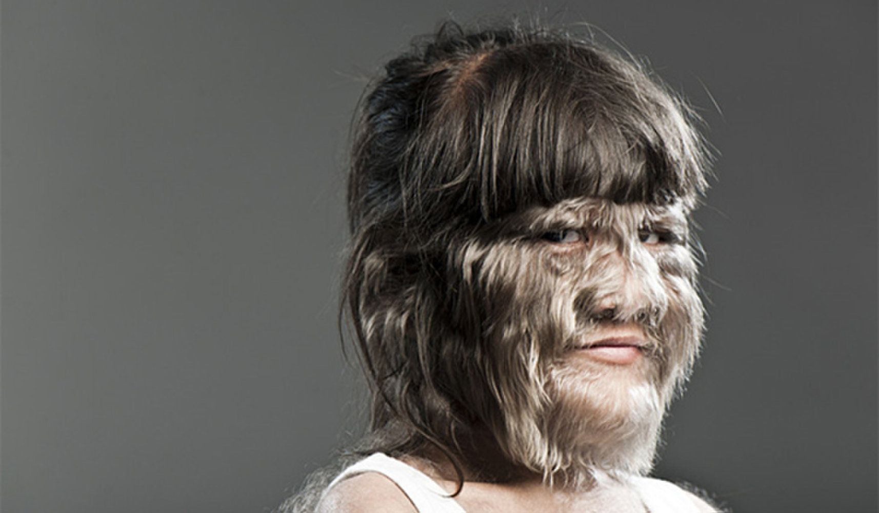 Hypertrichosis Terminalis