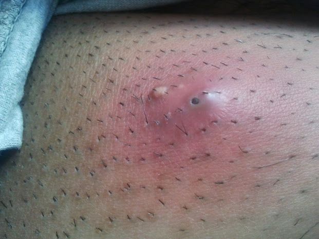 Antibiotik yang Tepat untuk Mengatasi Bisul, Cara Mengobatinya di Rumah ...