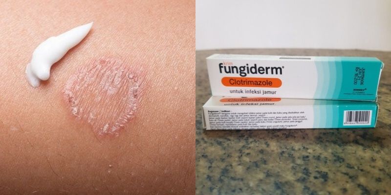 5 Rekomendasi Obat Kurap di Apotek yang Efektif dan Aman Digunakan