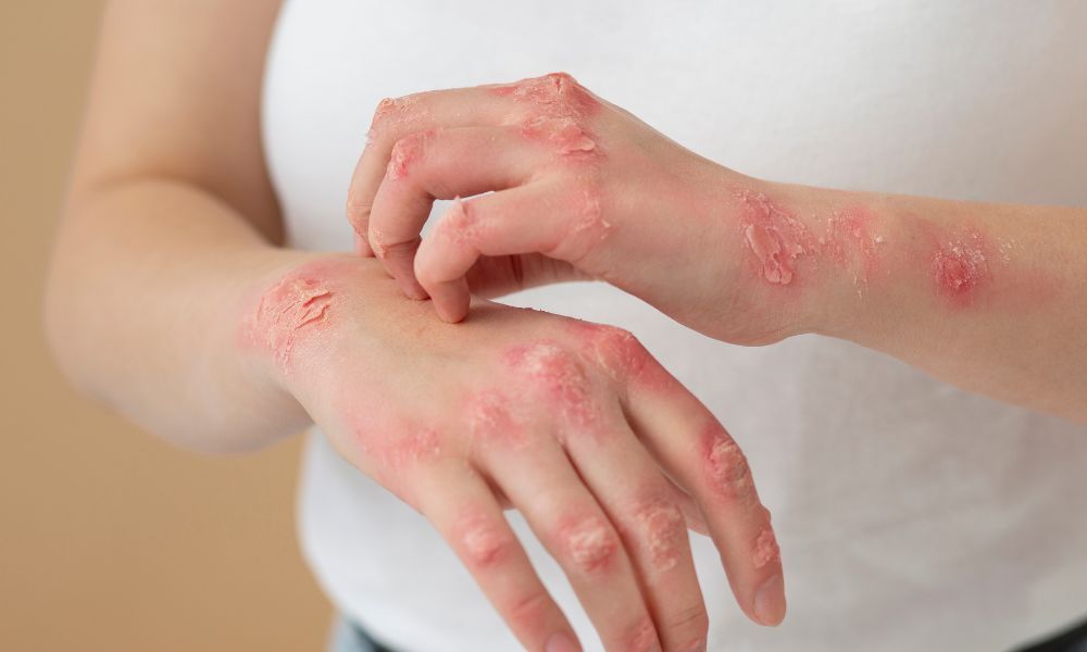Recognizing Signs Of Atopic Dermatitis Understanding Symptoms And Differences From Allergies