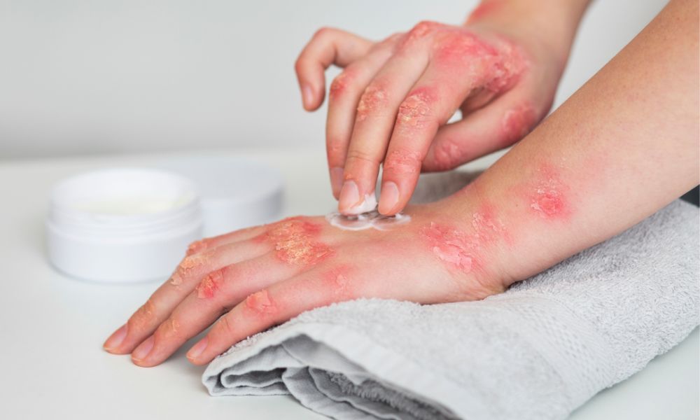 Cegah Ruam dan Gatal di Tangan, Cara Pakai Pemutih Baju untuk Kulit ...