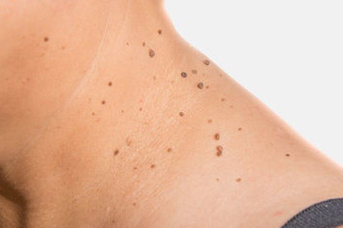 Tumbuh Kutil Hitam di Badan, Apakah Berbahaya? Jika Iya, Bagaimana ...