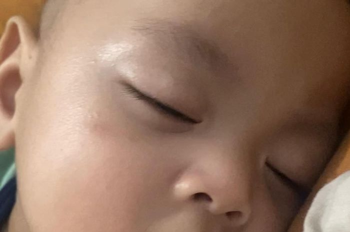 Tak perlu Khawatir, Ini Dia 4 Pengobatan Rumahan untuk Mengobati ...