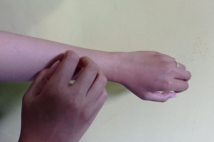 Hari Kusta Sedunia, Kenali Penularan Penyakit Kusta serta Cara ...