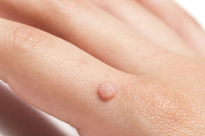 Hilangkan Kutil Cukup Pakai 5 Bahan Alami Ini. Enggak Minder Lagi ...