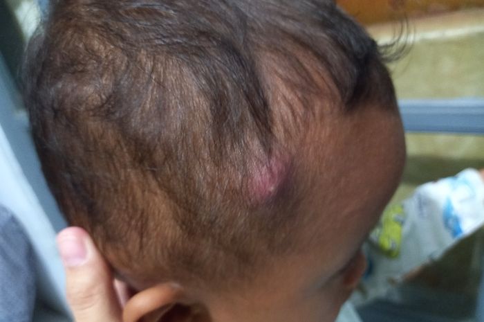 Bagian Tubuh Anak yang Rentan Terkena Bisul, Penyebab dan Cara ...