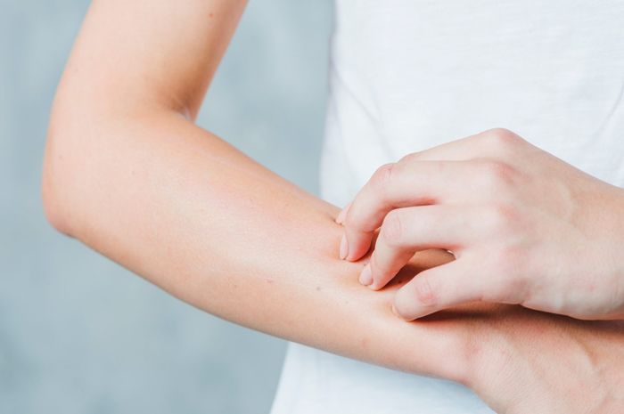 Apa Itu Eksim? Simak Jenis, Gejala, Hingga Pengobatan untuk Penyakit ...