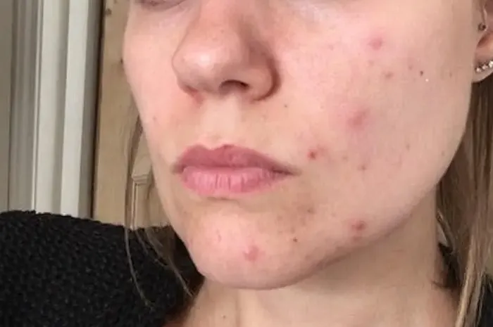 5 Penyebab Wajah Mulus Tiba-tiba Breakout, Gaya Hidup Paling Ngaruh ...