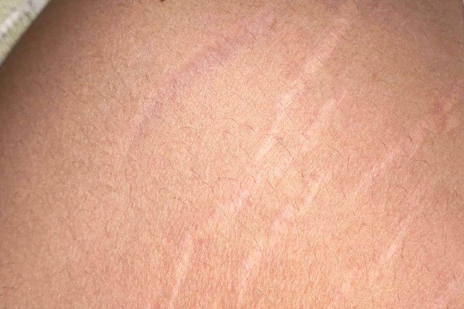 Berita 10 Rekomendasi Krim Penghilang Stretch Mark Terbaru Hari Ini ...