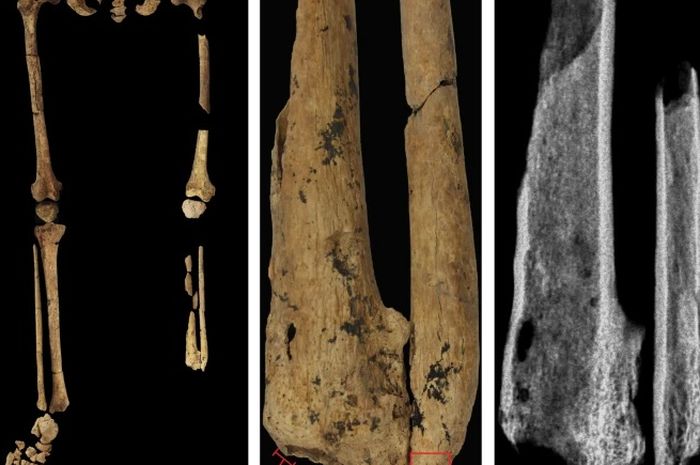 Bukti Amputasi Tertua pada Manusia Zaman Batu Ditemukan di Kalimantan ...